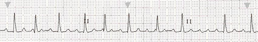 Ecg Basics Atrial Flutter With Variable Conduction Ecg Guru